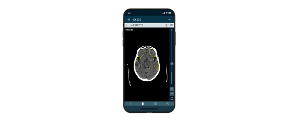 Medical AI and Stroke Care News | Brainomix